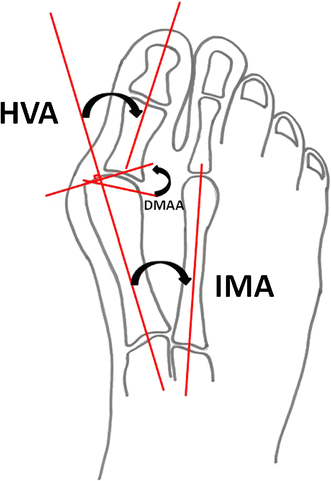 Adolescent hallux valgus: a systematic review of outcomes following ...