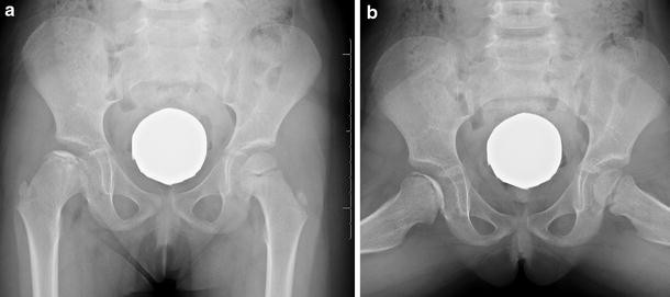 The presentation of Legg−Calvé−Perthes disease in females | SpringerLink