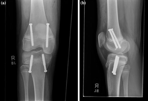 Percutaneous epiphysiodesis using transphyseal screws for limb-length ...