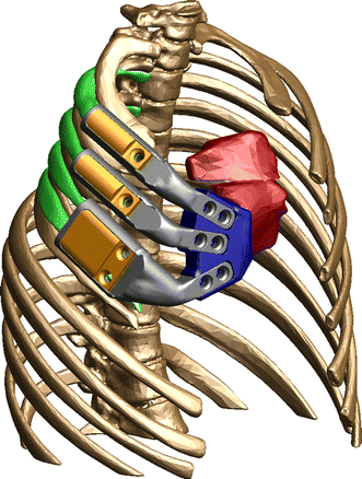A technique for pediatric chest wall reconstruction using custom ...