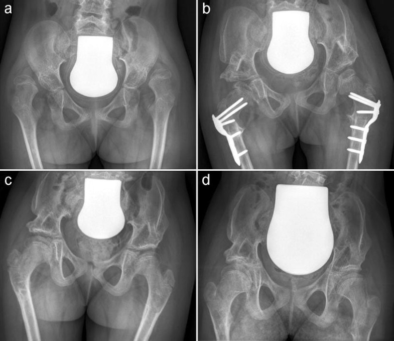 A balanced approach for stable hips in children with cerebral palsy: a ...