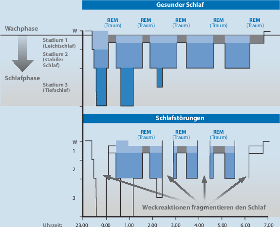 Schlafbruxismus und schlafbezogene Atmungsstörungen | SpringerLink