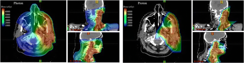Proton Therapy for Head and Neck Cancer | SpringerLink
