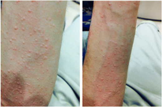 Review of Physical Urticarias and Testing Methods | SpringerLink