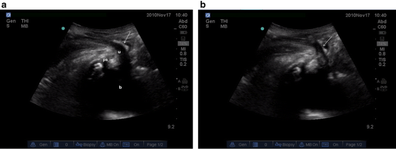 Clinical Application of Ultrasound in Male Voiding Dysfunction ...