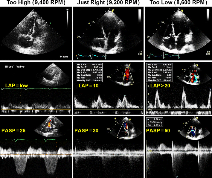 The Practical Role of Echocardiography in Selection, Implantation, and ...