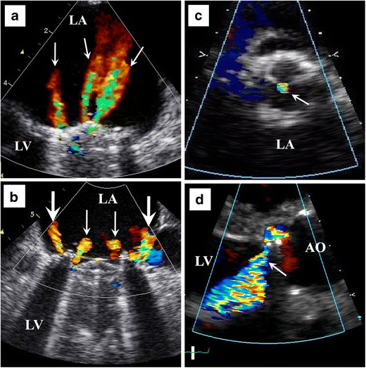 Echocardiographic Evaluation of Prosthetic Heart Valves | SpringerLink