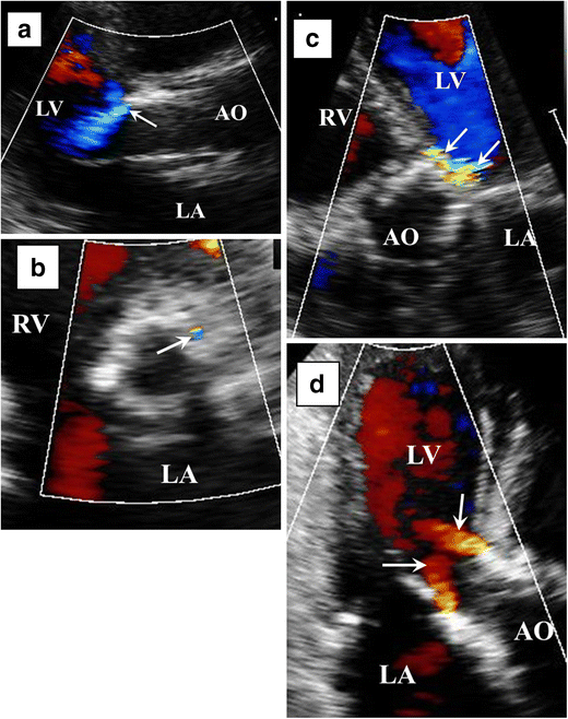 Echocardiographic Evaluation of Prosthetic Heart Valves | SpringerLink