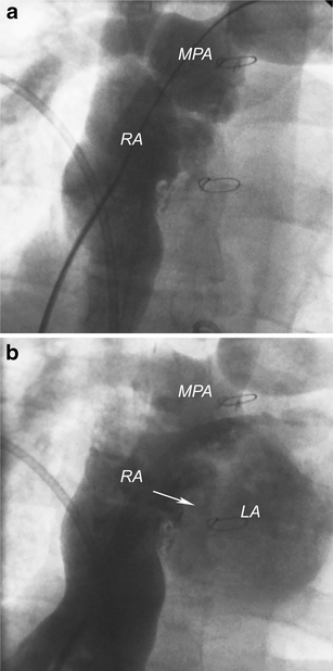 Clinical Approaches to the Patient with a Failing Fontan Procedure ...