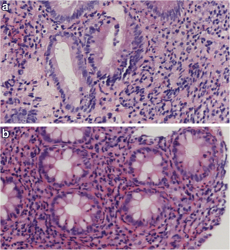 Diagnosis, Natural History and Treatment of Eosinophilic Enteritis: a ...