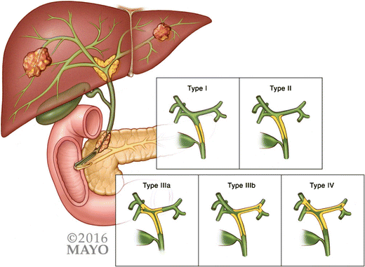 Looking Forward: Surgical Resection, Liver Transplantation, and Hilar ...