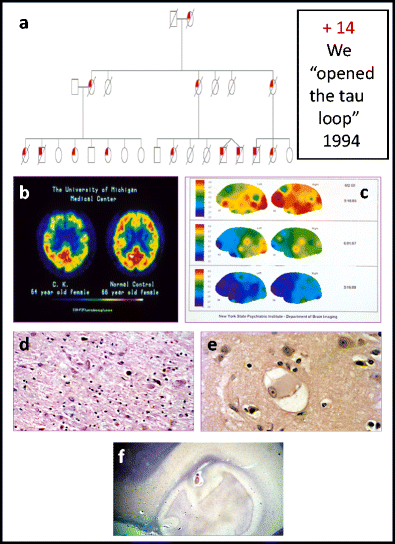 Genetics of Frontotemporal Dementia | SpringerLink
