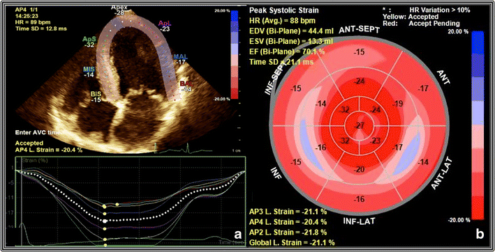 Cardiac Amyloidosis: Diagnosis and Treatment Strategies | SpringerLink