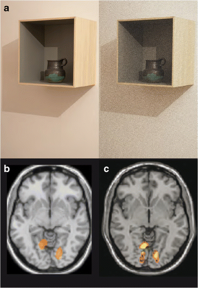 Visual Snow—Persistent Positive Visual Phenomenon Distinct from ...