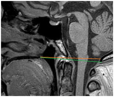 Basilar Invagination, Basilar Impression, and Platybasia: Clinical and ...