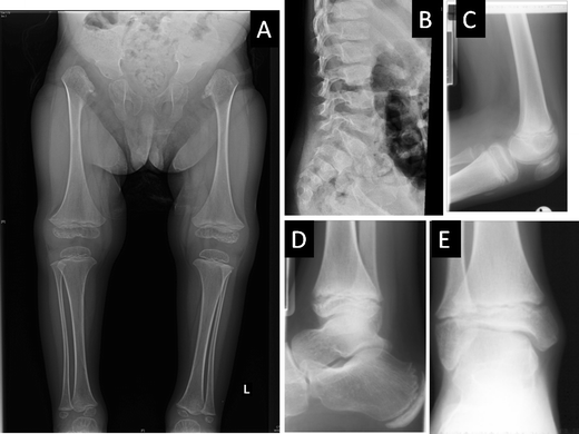 The Collagenopathies: Review of Clinical Phenotypes and Molecular ...