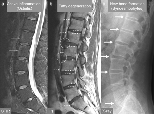 Mechanism of New Bone Formation in Axial Spondyloarthritis | SpringerLink