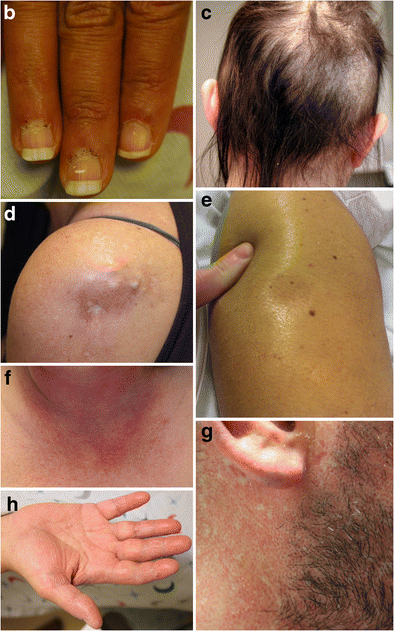 Dermatomyositis Clinical and Pathological Phenotypes Associated with ...