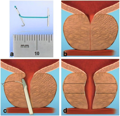 Prostatic Urethral Lift Versus Transurethral Resection of the Prostate ...