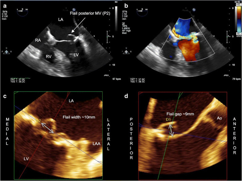 Percutaneous Mitral Valve Edge-to-Edge Repair for Degenerative Mitral ...