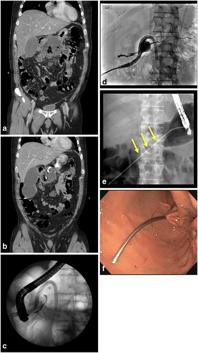 Management of Disconnected Pancreatic Duct Syndrome | SpringerLink