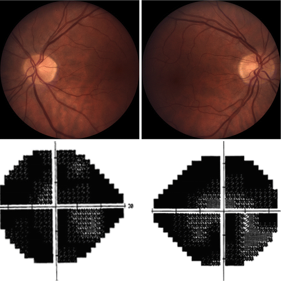 Treatment of Melanoma-Associated Retinopathy | SpringerLink