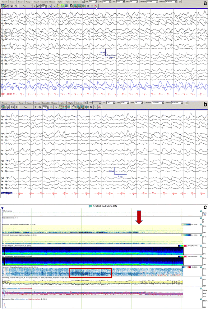 Ictal Interictal Continuum Patterns | SpringerLink