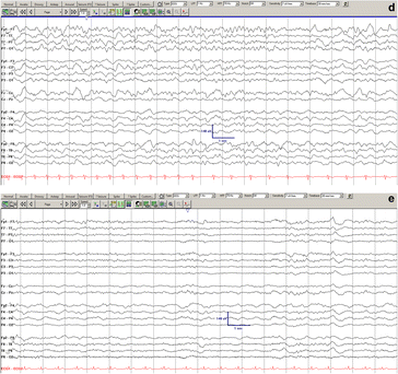 Ictal Interictal Continuum Patterns | SpringerLink