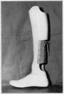 An Improved Prosthesis for a Syme Amputation | SpringerLink