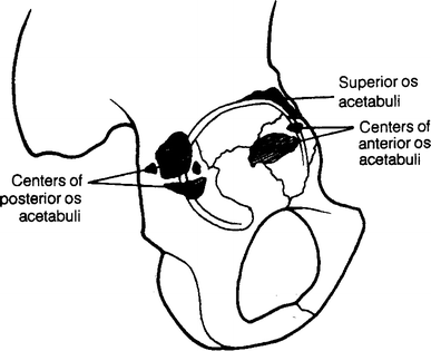 The Limbus and the Neolimbus in Developmental Dysplasia of the Hip ...