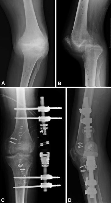 Surgical Technique: Articulated External Fixator for Treatment of ...