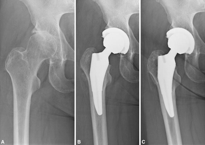 A Short Tapered Stem Reduces Intraoperative Complications in Primary ...