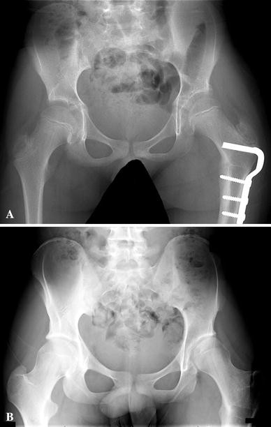 Multilevel Surgery Improves Gait in Spastic Hemiplegia But Does Not ...