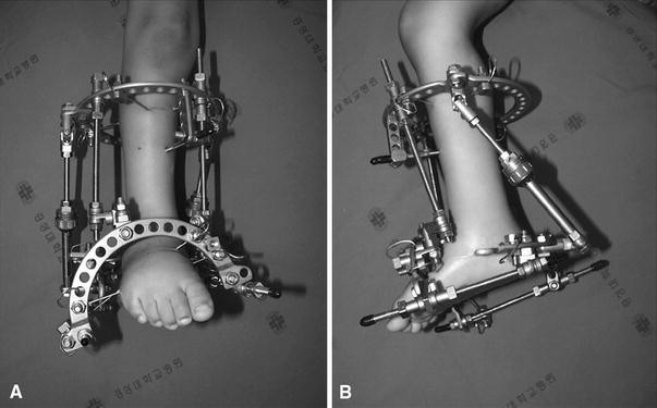 Does Short-term Application of an Ilizarov Frame with Transfixion Pins ...