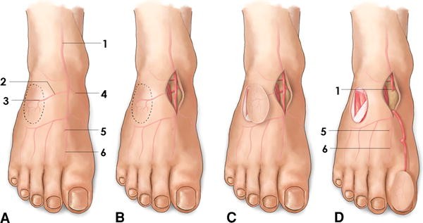 Surgical Technique: Repair of Forefoot Skin and Soft Tissue Defects ...