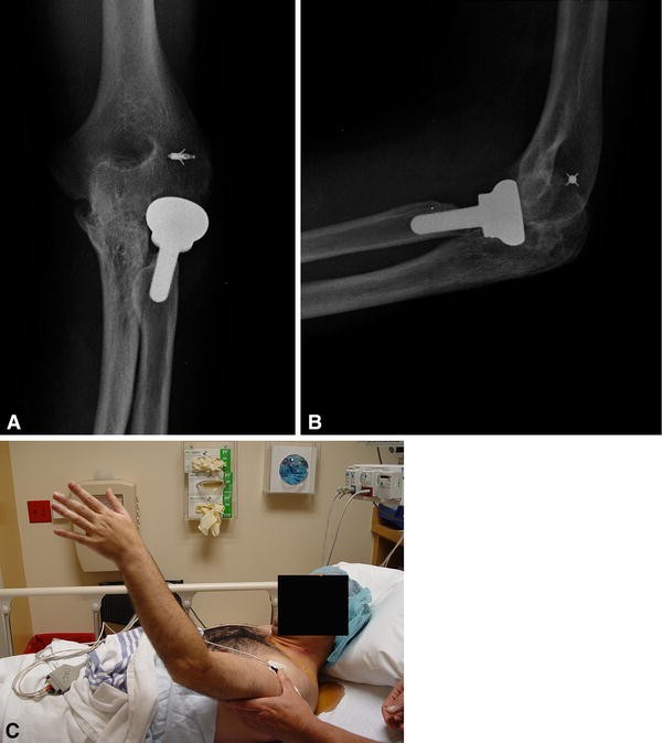 The Management of Elbow Instability Using an Internal Joint Stabilizer ...