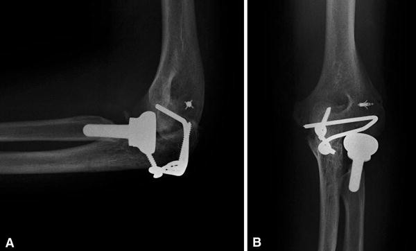 The Management of Elbow Instability Using an Internal Joint Stabilizer ...