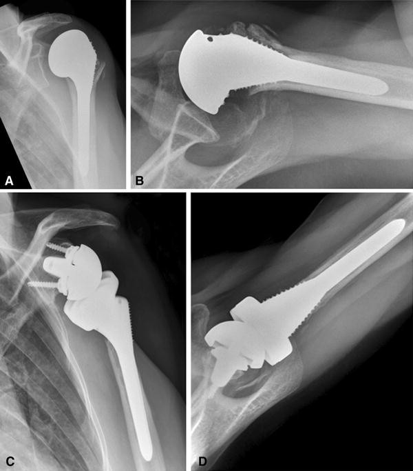 Conversion of Stemmed Hemi- or Total to Reverse Total Shoulder ...