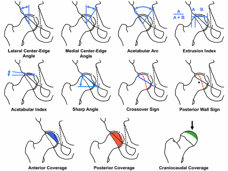 What Are the Radiographic Reference Values for Acetabular Under- and ...