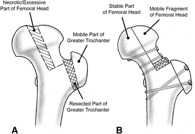 Head Reduction Osteotomy With Additional Containment Surgery Improves ...
