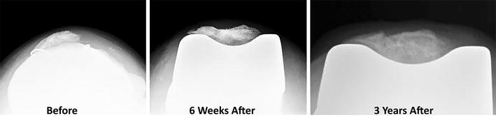 What Is the Role for Patelloplasty With Gullwing Osteotomy in Revision ...