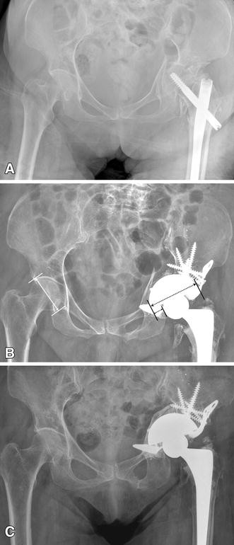 Does Cup-cage Reconstruction With Oversized Cups Provide Initial ...