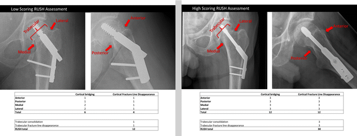 The Radiographic Union Score for Hip (RUSH) Identifies Radiographic ...