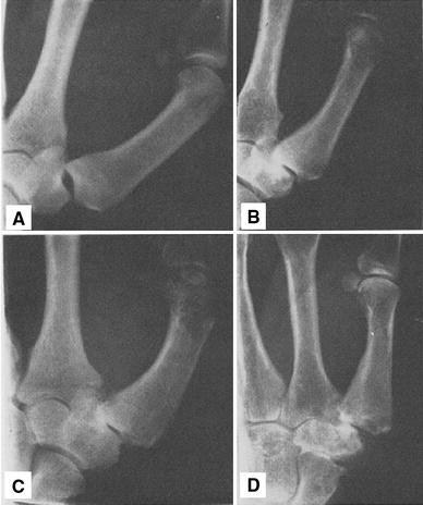 Classifications in Brief: The Eaton-Littler Classification of Thumb ...