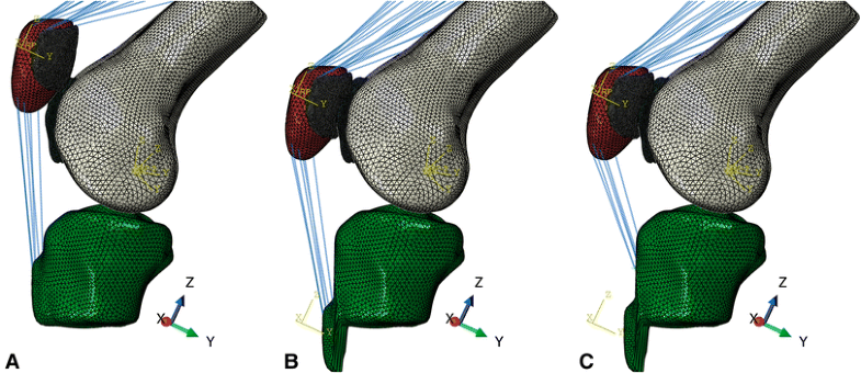 Does Patella Tendon Tenodesis Improve Tibial Tubercle Distalization in ...