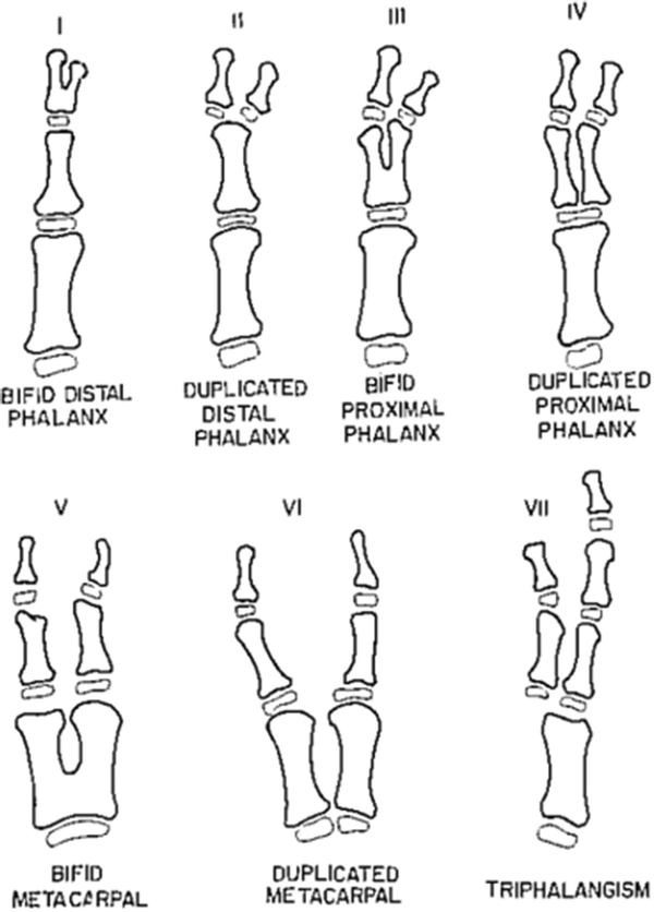 Classifications in Brief: The Wassel Classification for Radial ...