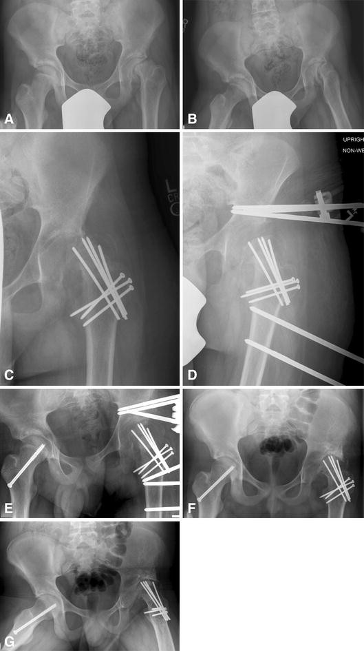 Iatrogenic Hip Instability Is a Devastating Complication After the ...