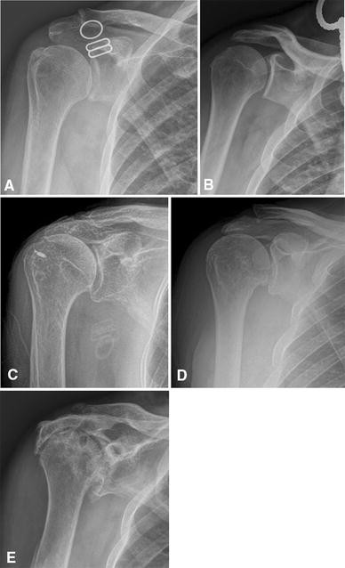Classifications in Brief: Hamada Classification of Massive Rotator Cuff ...