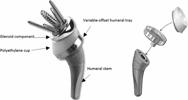 Biomechanical analysis of the humeral tray positioning in reverse ...