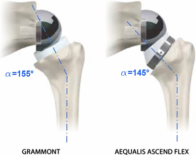 Biomechanical analysis of the humeral tray positioning in reverse ...